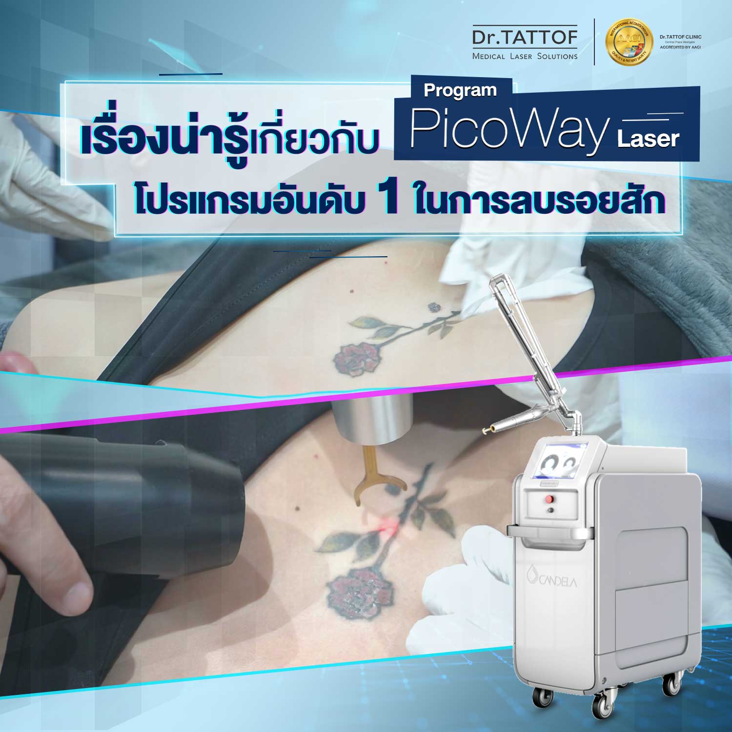 เรื่องน่ารู้เกี่ยวกับ Program PicoWay Laser โปรแกรมอันดับ 1 ในการลบรอย ...